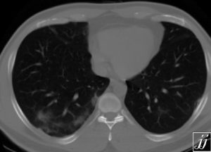 Accessory odontoid process – Radiopaedia