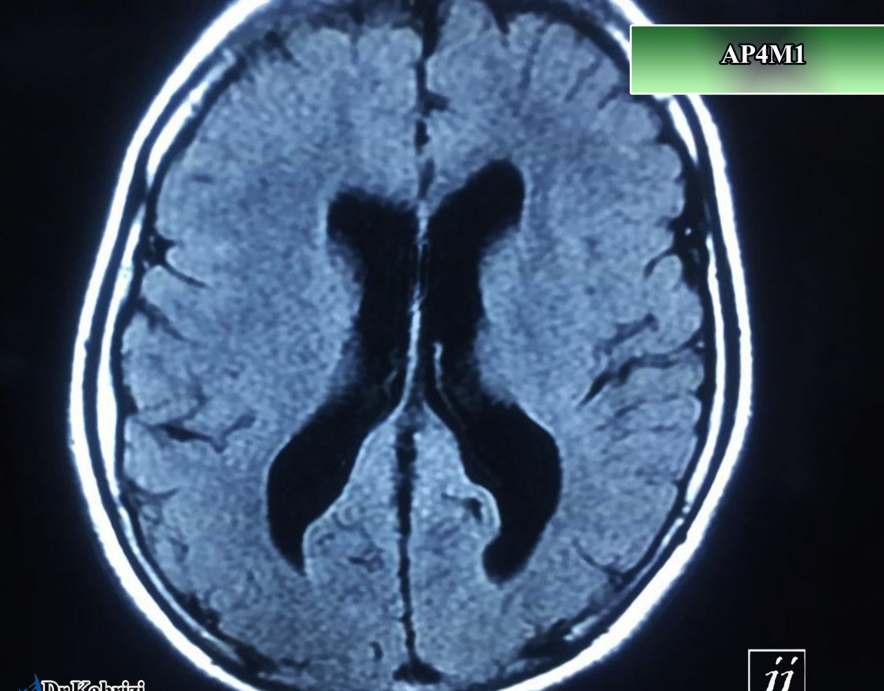 Genetic and Neuroimaging – Radiopaedia