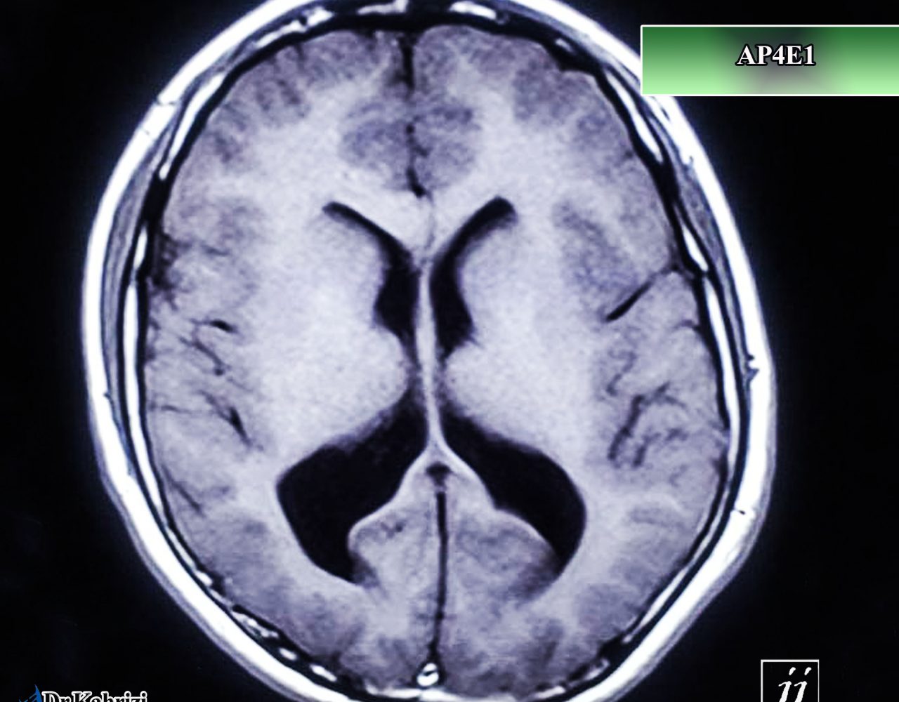 Genetic and Neuroimaging – Radiopaedia