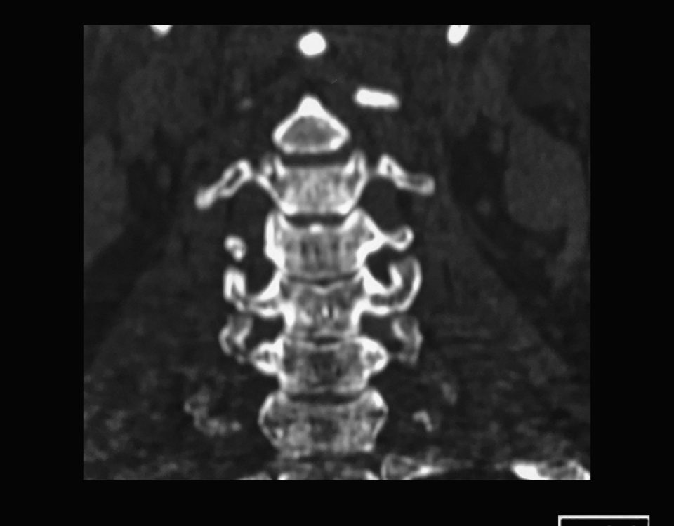 MSK-iliac bone-Pareidolia – Radiopaedia